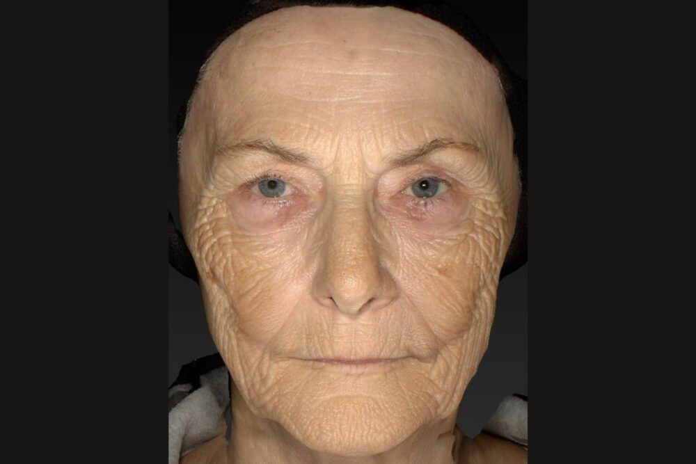 Face Archives | Brisbane Skin, Dermatologist Brisbane. Medical ...