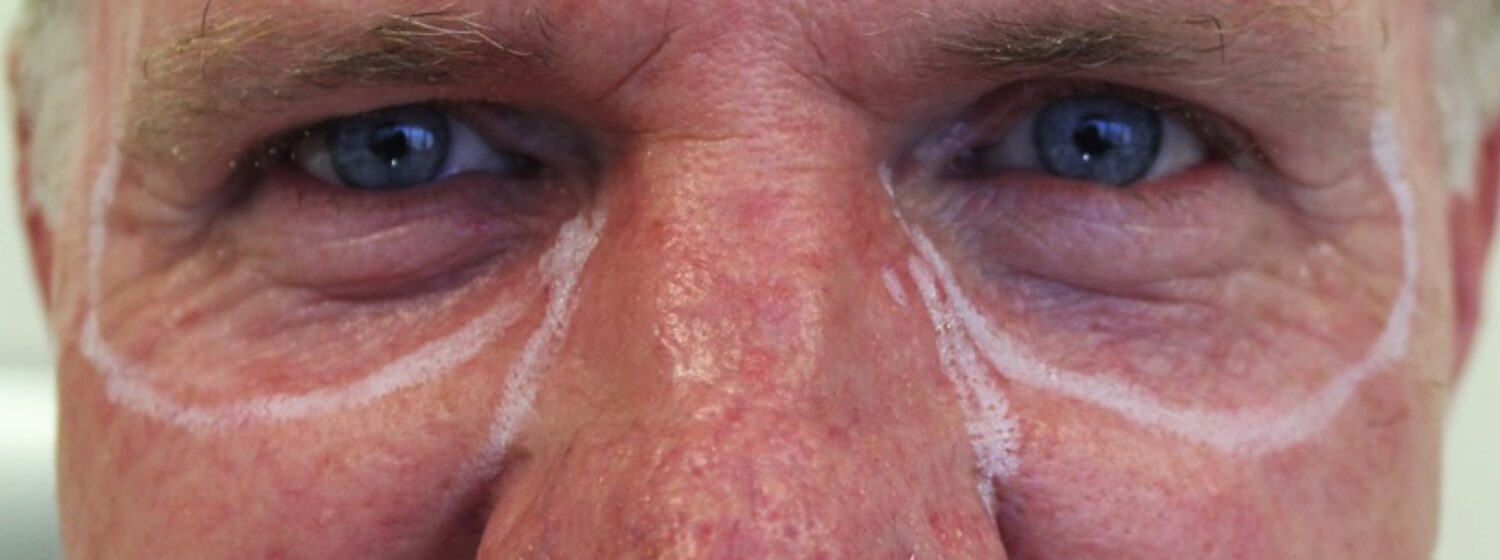 Eye Rejuvenation Archives | Brisbane Skin, Dermatologist Brisbane ...