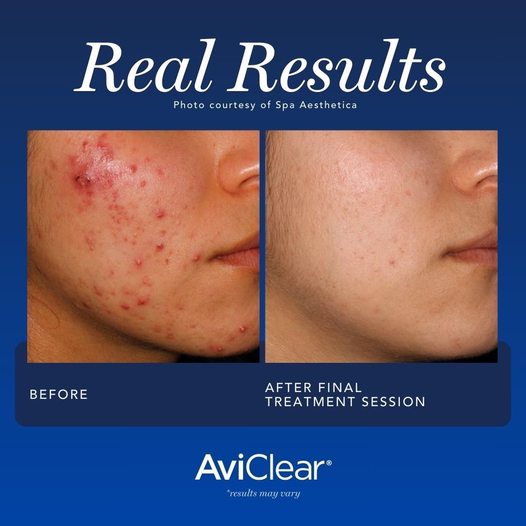 Acne Treatments | Brisbane Skin Dermatologist