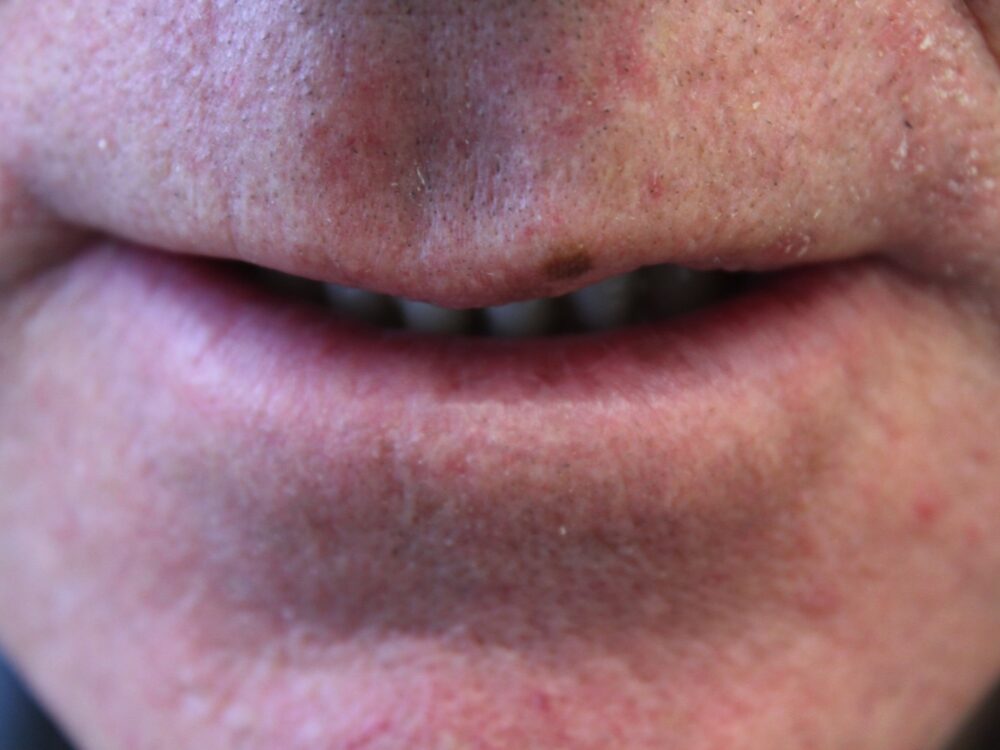 Lips Archives | Brisbane Skin, Dermatologist Brisbane. Medical ...
