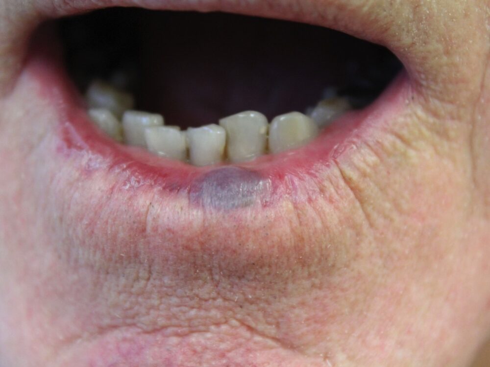 Lips Archives | Brisbane Skin, Dermatologist Brisbane. Medical ...