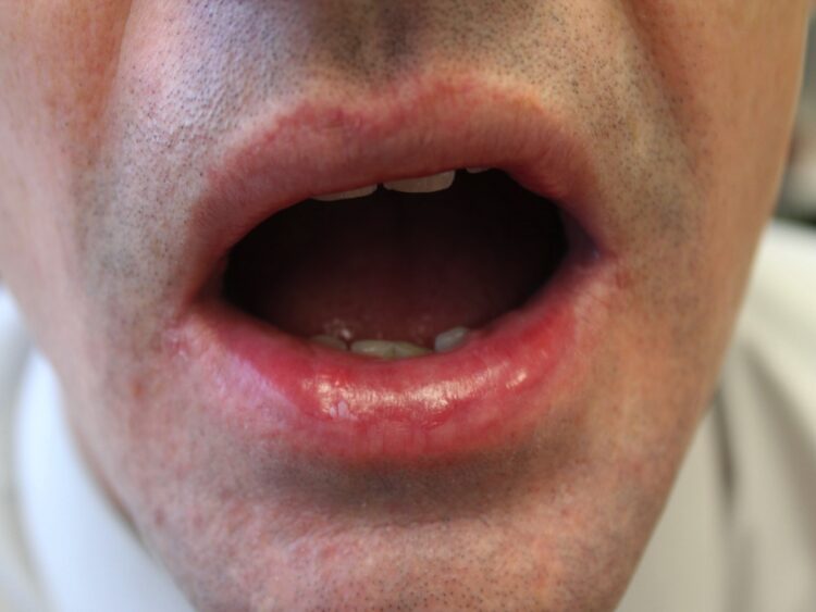 Lips Archives | Brisbane Skin, Dermatologist Brisbane. Medical ...