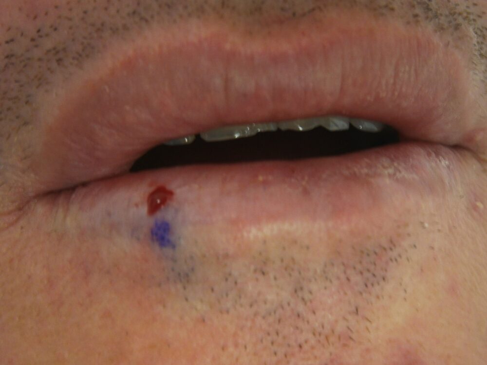 Lips Archives | Brisbane Skin, Dermatologist Brisbane. Medical ...