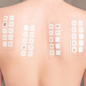 Patch Testing | Brisbane Skin, Dermatologist Brisbane. Medical ...