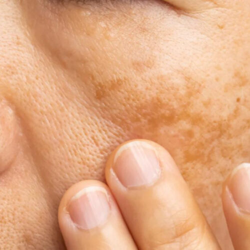 Brown spots, pigmentation & freckles | Brisbane Skin, Dermatologists