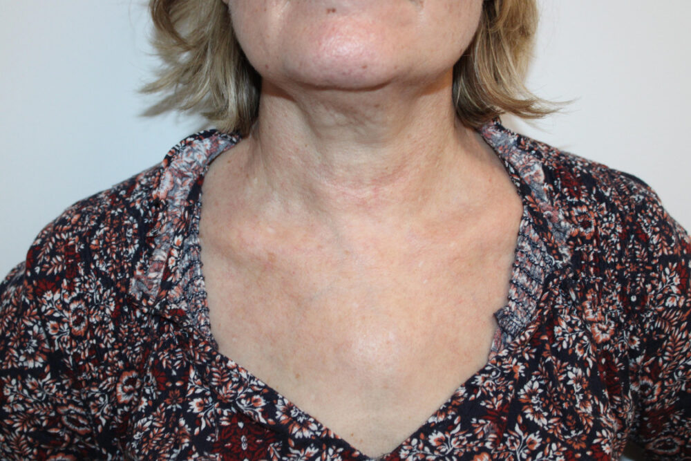 Sun Damage | Brisbane Skin, Dermatologist Brisbane. Medical, surgical ...