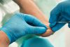 Ingrown Toenails | Brisbane Skin, Dermatologist Brisbane. Medical ...