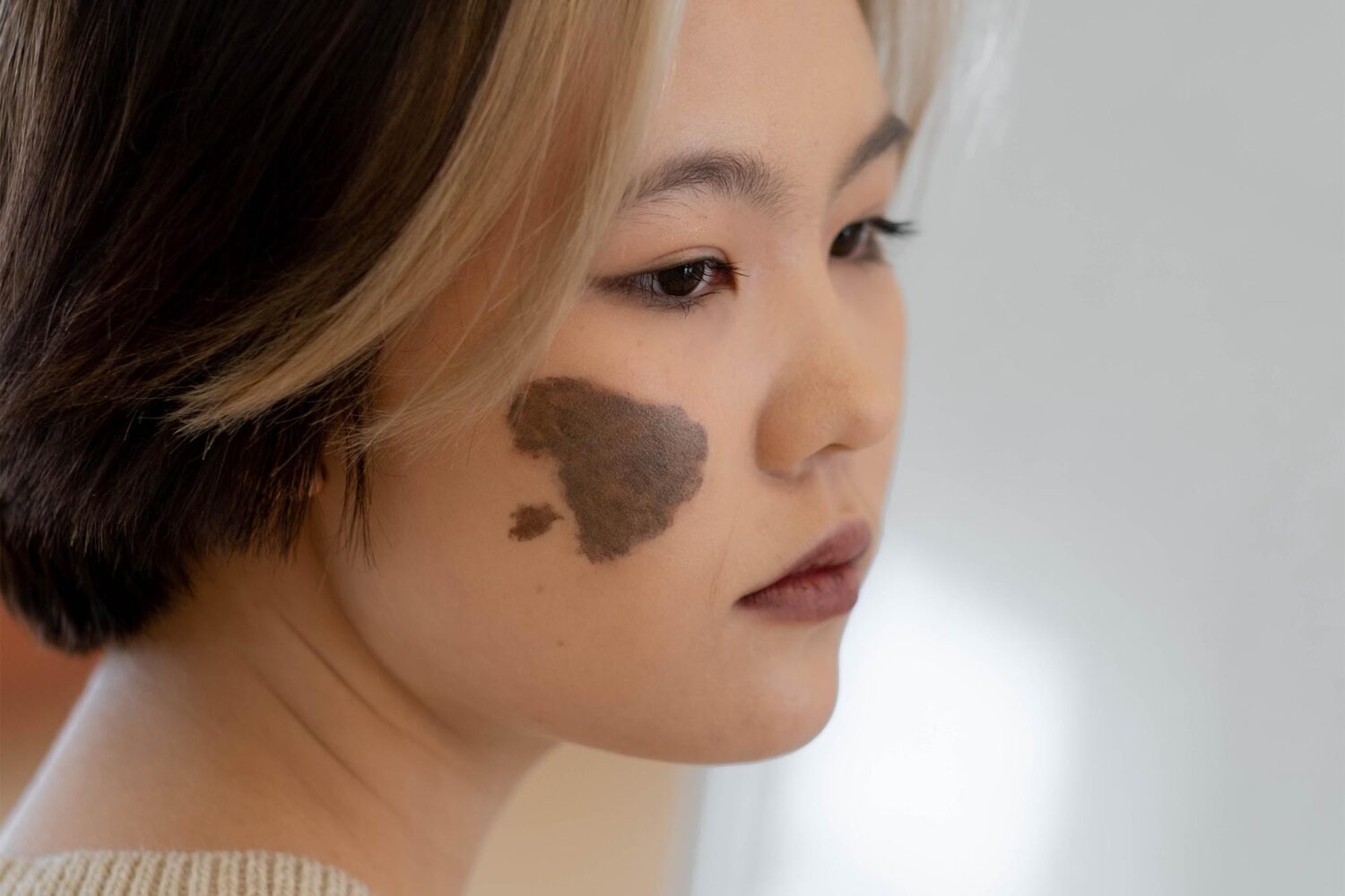 Birth Marks | Brisbane Skin, Dermatologist Brisbane. Medical, surgical, cosmetic