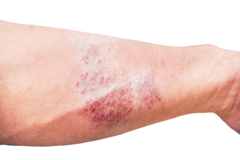 Dermatitis and Eczema Treatment | Brisbane Skin Dermatologists