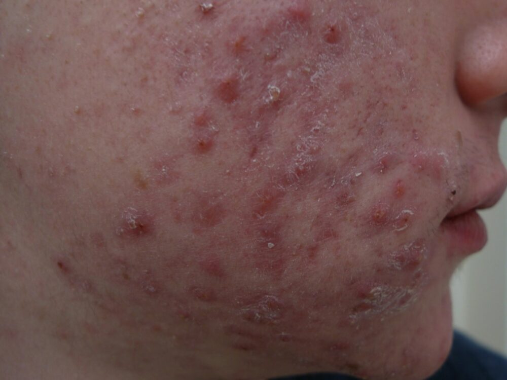 Acne Treatments | Brisbane Skin Dermatologist