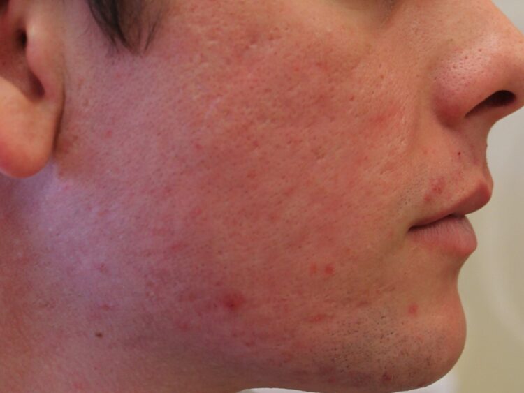 Acne Treatments | Brisbane Skin Dermatologist