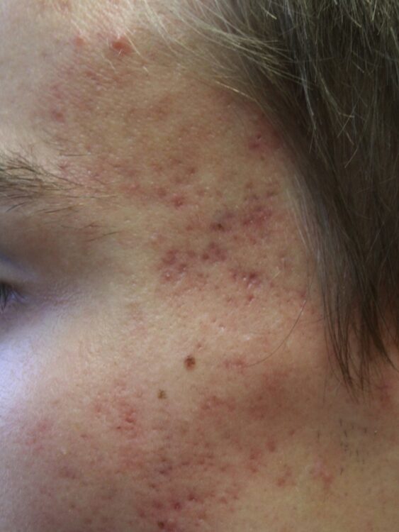 Acne Scar Treatment & Removal | Brisbane Skin