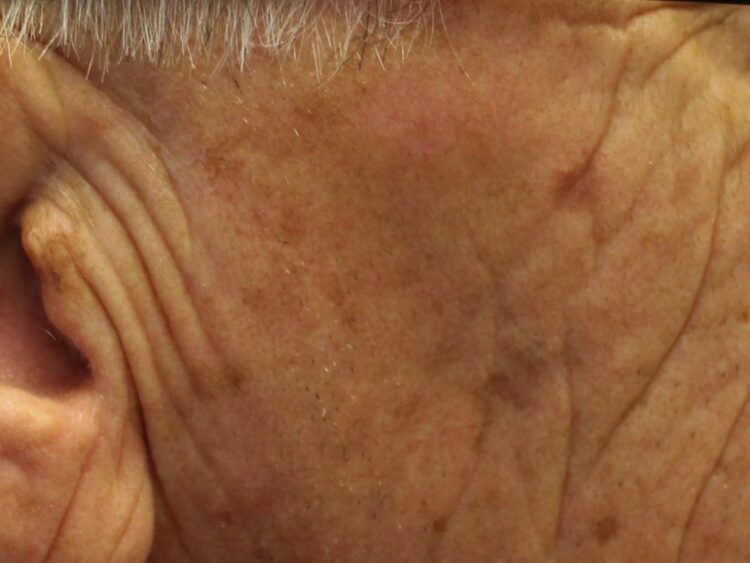 Pigmentation Before and After | Brisbane Skin Dermatologists