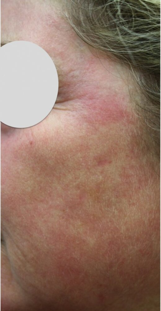 Pigmentation Before and After | Brisbane Skin Dermatologists