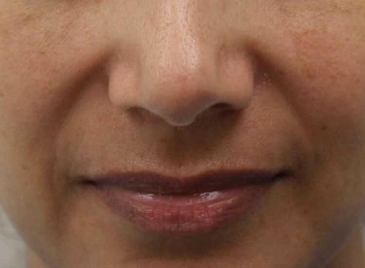 Pigmentation Before and After | Brisbane Skin Dermatologists