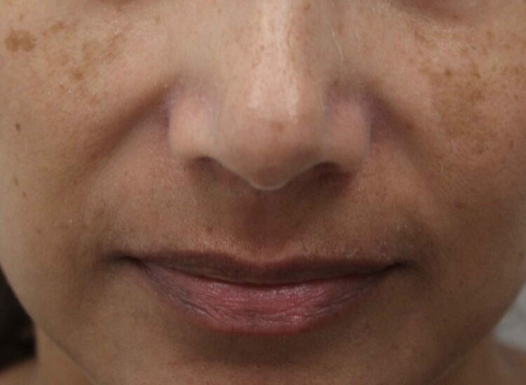 Pigmentation Before and After | Brisbane Skin Dermatologists