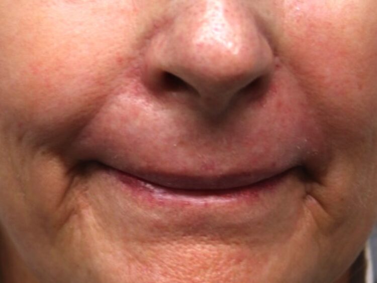 Pigmentation Before and After | Brisbane Skin Dermatologists