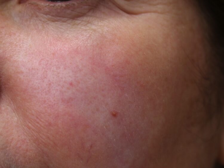 Scars Before and After | Brisbane Skin Dermatologists