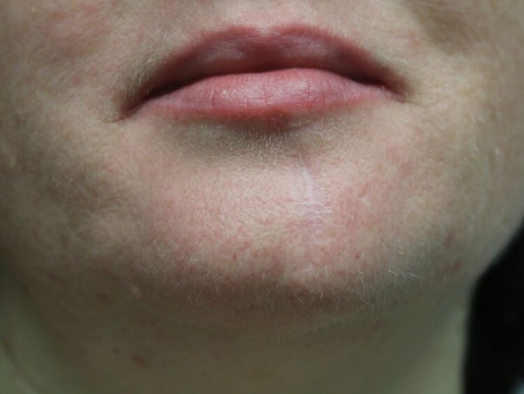 Scars | Brisbane Skin, Dermatologist Brisbane. Medical, surgical, cosmetic