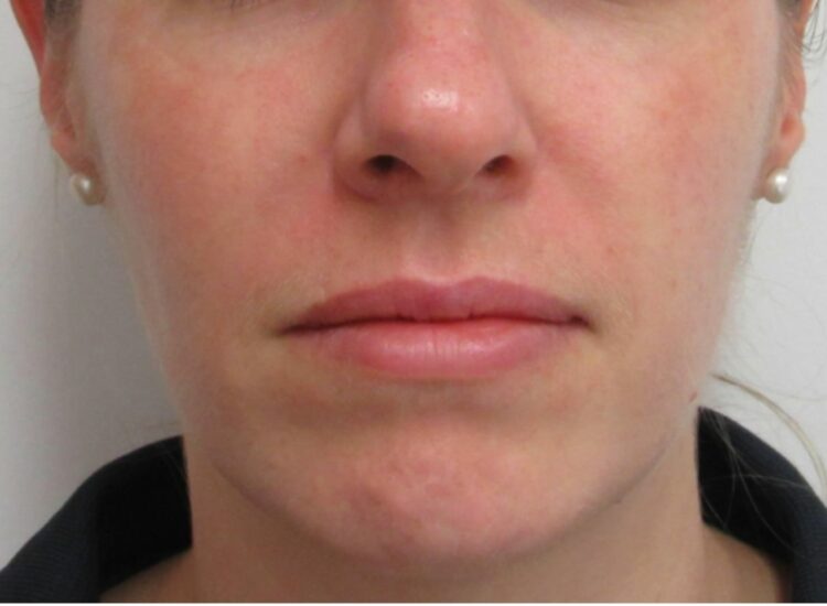 Scars Before and After | Brisbane Skin Dermatologists