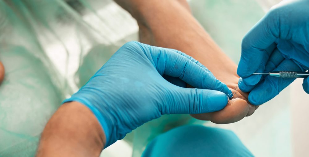 Ingrown Toenails | Brisbane Skin, Dermatologist Brisbane. Medical ...