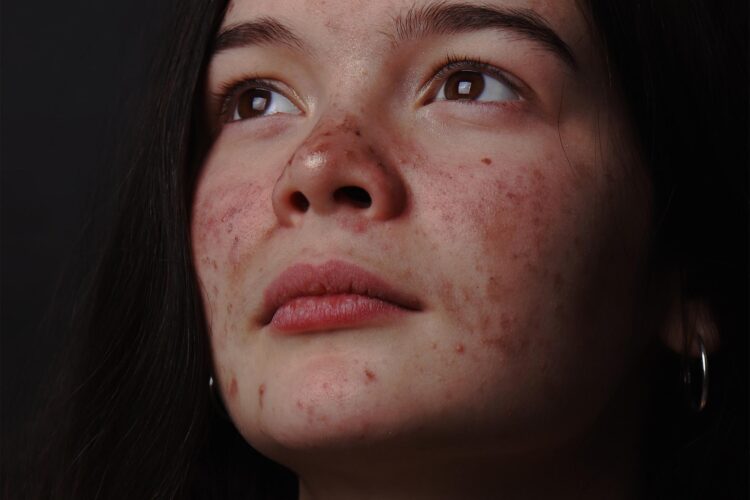 Post Inflammatory Hyperpigmentation | Brisbane Skin, Dermatologist ...