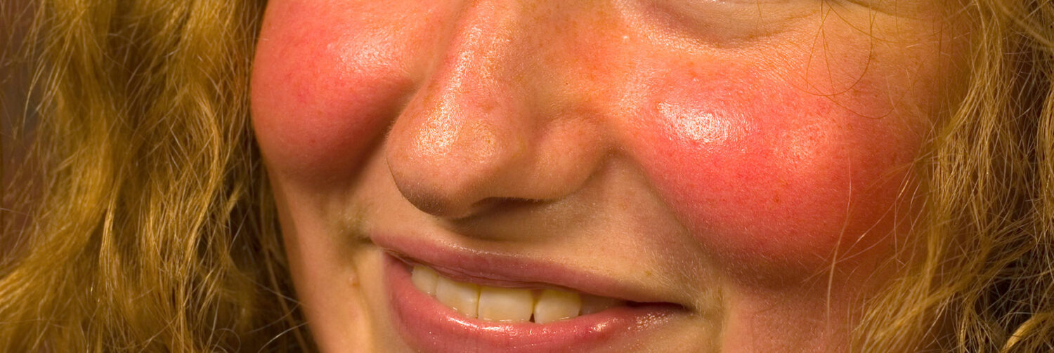 Rosacea Treatment | Brisbane Skin Dermatologists