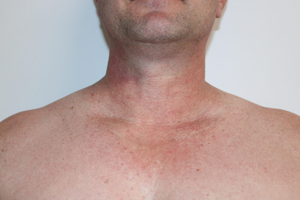 Sun Damage | Brisbane Skin, Dermatologist Brisbane. Medical, surgical ...